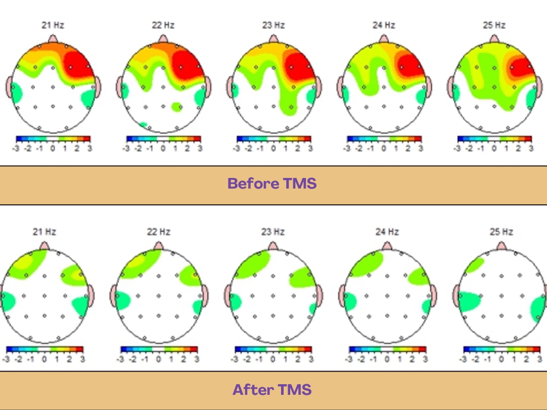 Why qEEG Brain Mapping Is Needed for Effective TMS Treatment